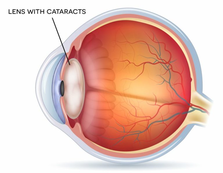 Cataract Treatment Perth - WA Eye Specialists Call (08) 9301 5568